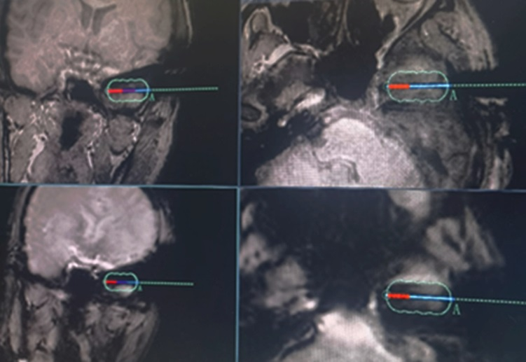 兰大二院完成甘肃省首例MRI引导下激光间质热疗术（LITT）治疗难治性癫痫_兰州大学新闻网